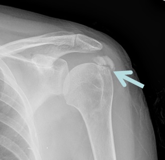 COMMON CONDITIONS – Derby Shoulder Unit